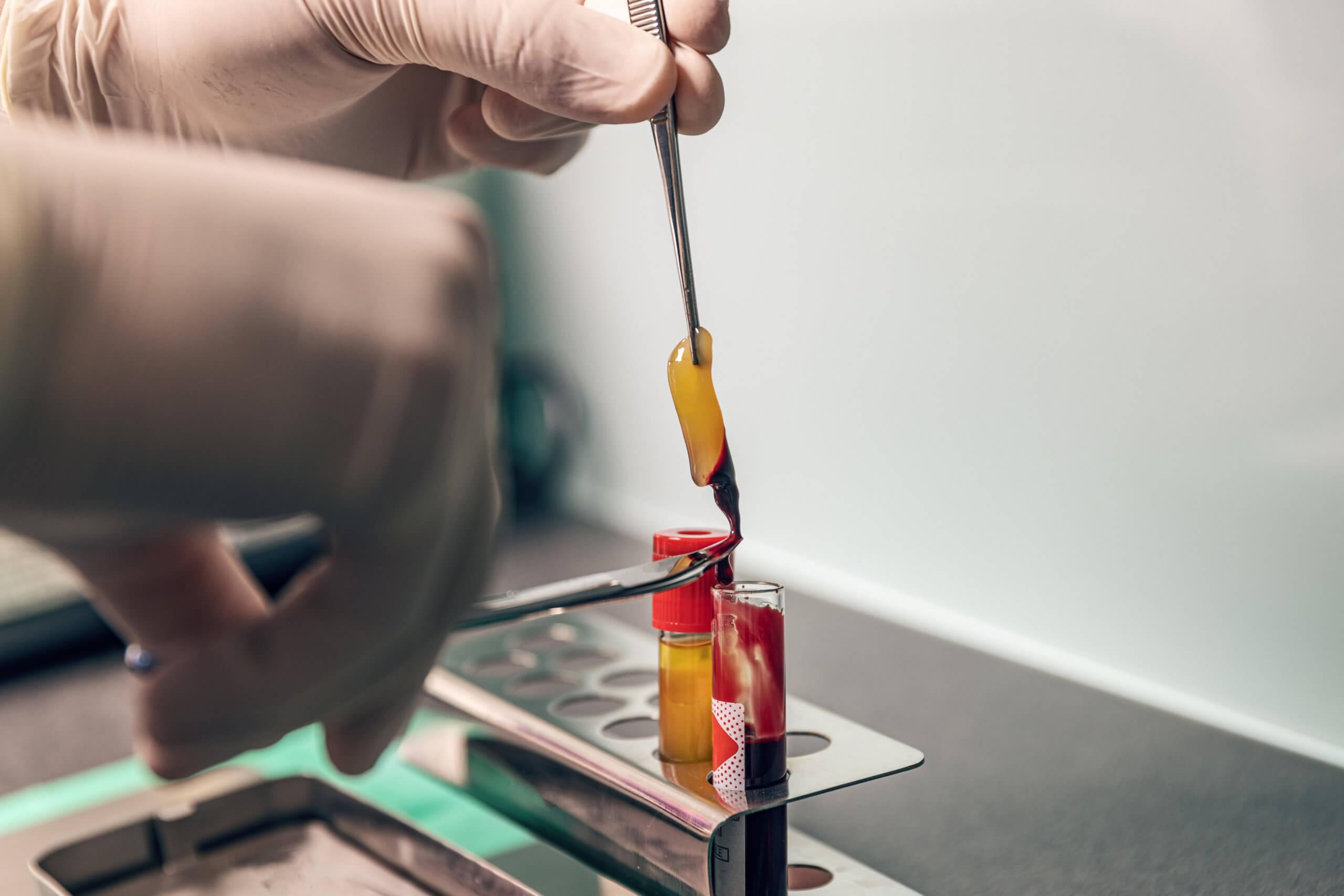 PRF( Platelet-Rich Fibrin) vs. Traditional Treatments