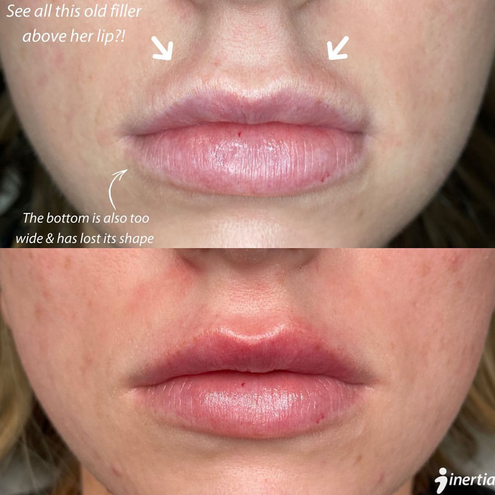 Before and After Kybella Photo Gallery - Remarkable Results