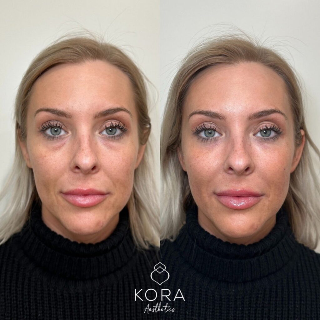 Before and After PRF EZ Gel Photo Gallery - Remarkable Results